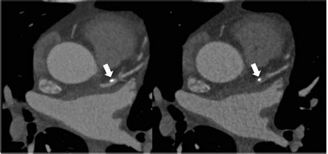 Coronary Artery Calcification Current Concepts And Clinical Implications Circulation