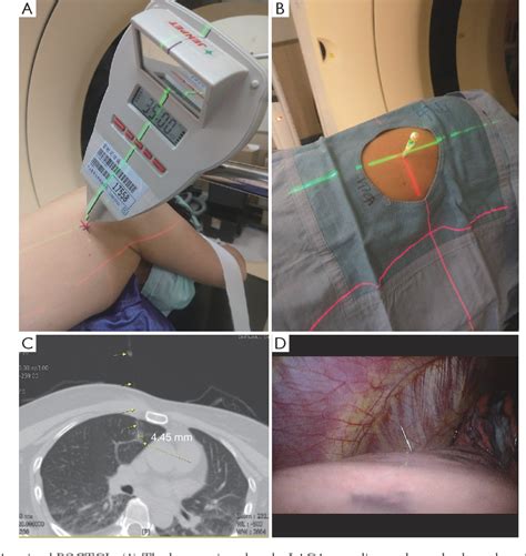 Figure 1 From Preoperative Computed Tomography Guided Pulmonary Nodule