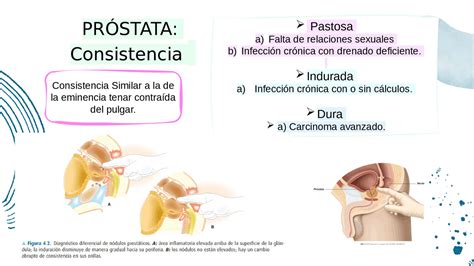 Que Es La Prostata Cancer En La Prostata Vzbspr