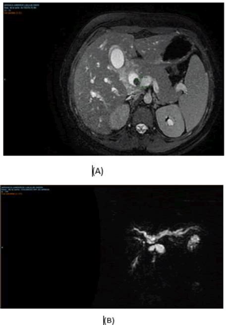 Cholecystitis Cholangitis And Choledocholithiasis Presentation