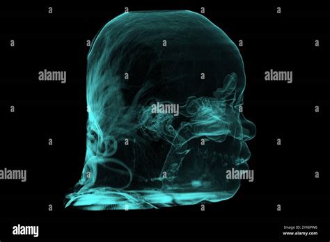Coloured 3d Computed Tomography Ct Scan Of A Head Showing The Healthy