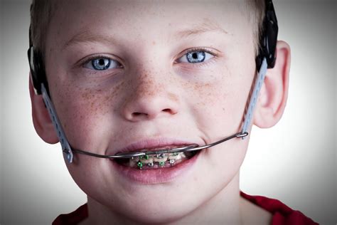 Orthodontic Headgear Before And After At Sandra Mathers Blog