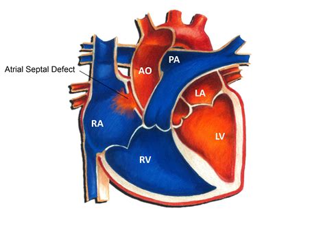 Atrial Septal Defect Anatomy My Xxx Hot Girl