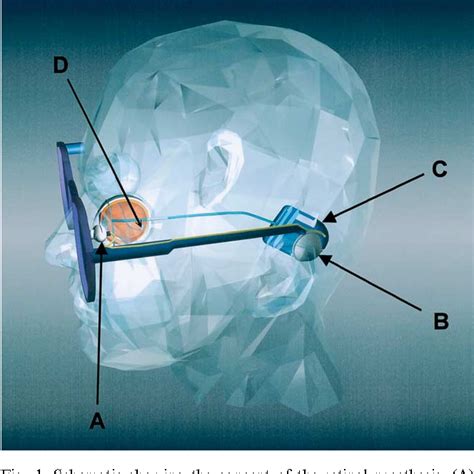 Visual Prosthesis Semantic Scholar