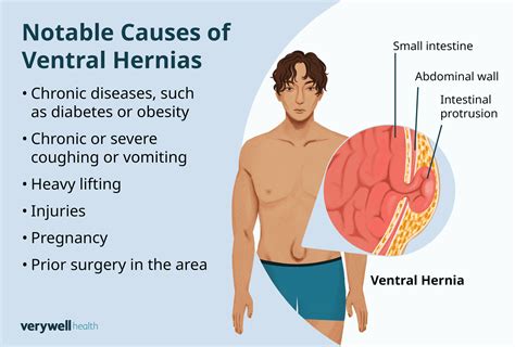 understanding ventral hernia