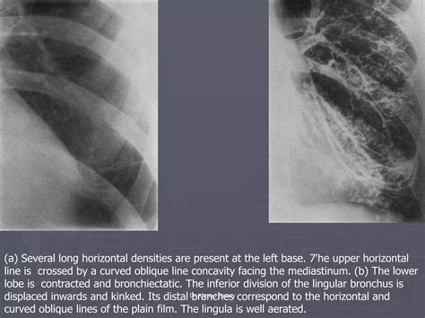 Linear Lung Density X Ray Dr Ahmed Esawy Pdf