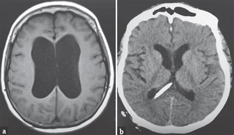 Normal Pressure Hydrocephalus Ct