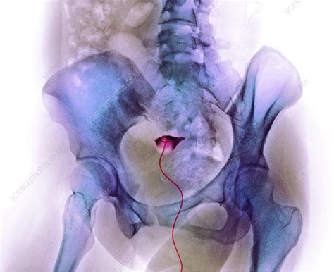 Blocked Fallopian Tube X Ray Stock Image F0378142 Science Photo