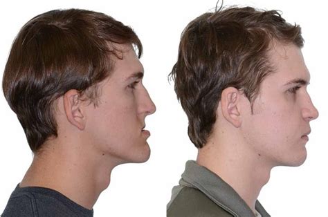 How To Mew With Overbite Underbite Crossbite And Open Bite