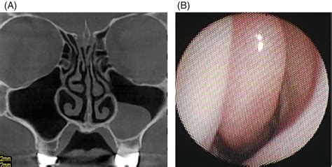 Collaboration Between Otolaryngologists And Oral Surgeons In Maxillary