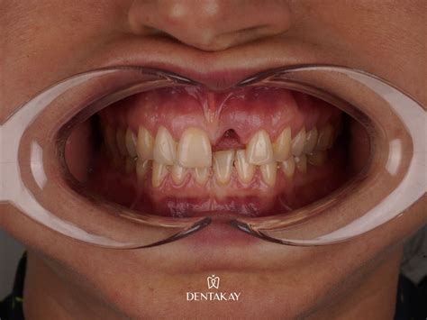 Does Byte Work My Honest Byte Aligners Review 2023 Artofit