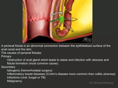 Anal Perianal Imaging Part 2 Perianal Fistula Ct Mri Dr Ahmed Esawy Pdf