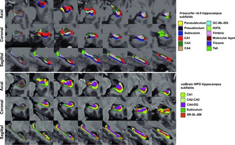 An Example Of Hippocampal Subfield Segmentation By Freesurfer Upper