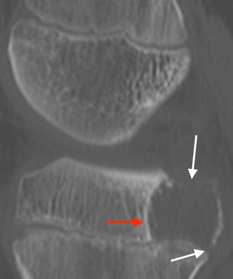 Chondroblastoma Of The Proximal Tibia Eurorad