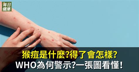 猴痘是什麼？得了會怎樣？who為何警示？一張圖看懂！ 健康大小事 生活 Nownews今日新聞