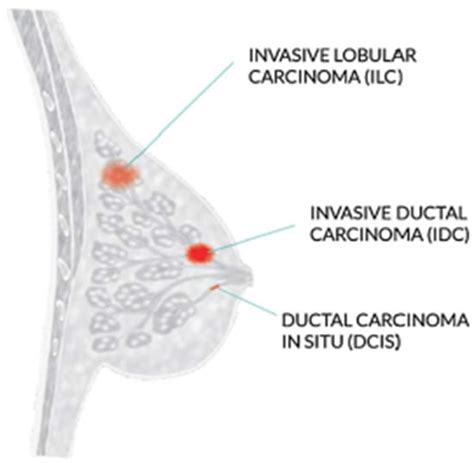 Understanding Invasive Ductal Carcinoma Stages Essential Guide Wgkpse