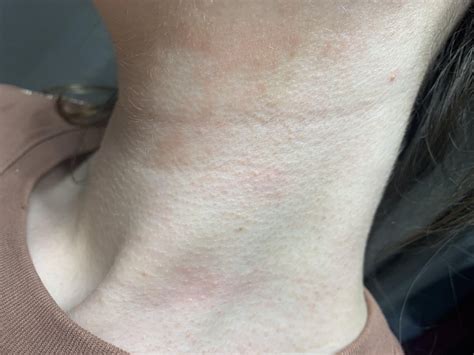 Rash On Neck Not Really Itchy Rskin
