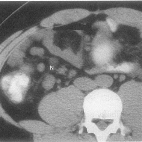 Section Of The Appendix Hyperplasia Of The Lymphatic Tissue Is Evident