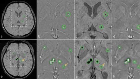Cerebral Microbleed Detection Using Susceptibility Weighted Imaging And Deep Learning Spintech Mri