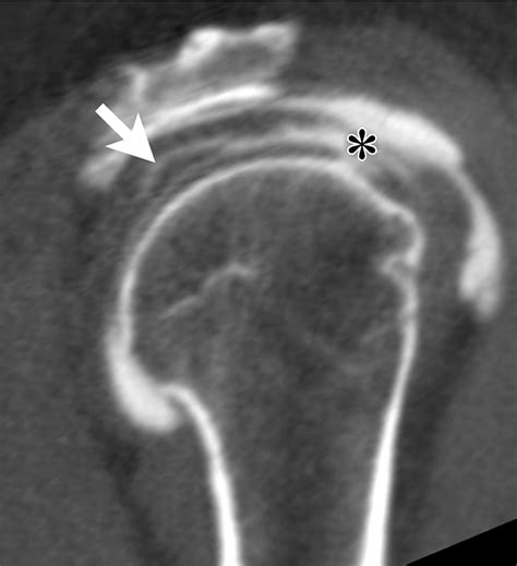Rotator Cuff Right Shoulder Icd 10 At Jeremy Fenner Blog
