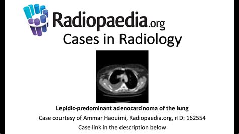 Lepidic Predominant Adenocarcinoma Of The Lung Cases