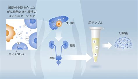 たった1回の採尿ですい臓がんを早期発見可能に！尿中マイクロrnaですい臓がんを高精度に検知 Craif株式会社のプレスリリース