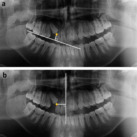 Linear Measurements Using Panoramic Radiography Linear Measurements Download Scientific