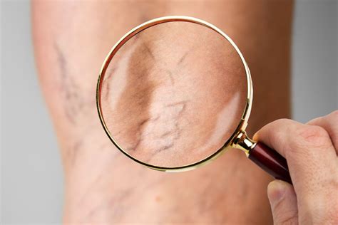 Tromboflebite Superficial Causa E Tratamento