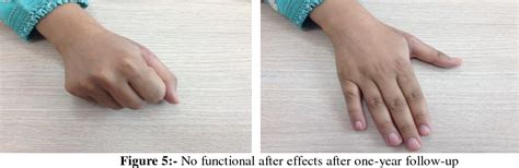 Figure 5 From Osteoid Osteoma Of The First Metacarpal Bone A Case Report Semantic Scholar