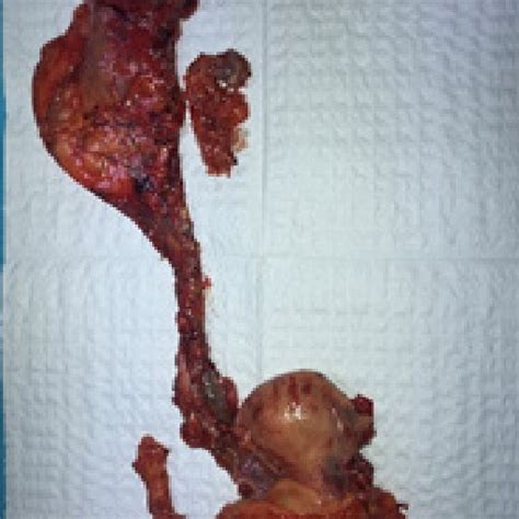 The Specimen Removed After Laparoscopic Radical Cystoprostatectomy And Download Scientific