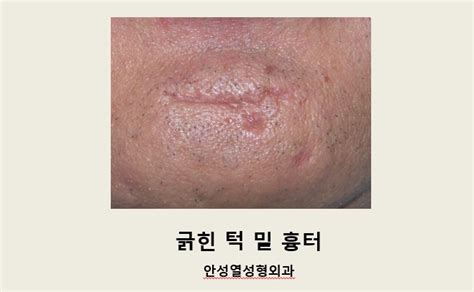 안성열 성형외과 피부과 긁히고 패인 수술흉터까지 남은 얼굴 흉터들 얼굴은 눈에 쉽게 보여지는