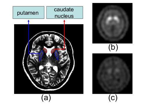 Examples Of T2 Weighted Mri And 99m Tc Trodat 1 Spect A Mri Image Download Scientific