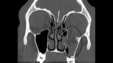 Broken Eye Socket Picture Treatment Recovery