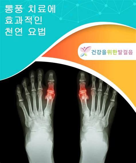 통풍 치료에 효과적인 천연 요법 통풍 자연요법 대체의학