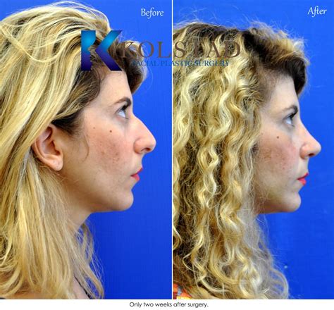 Hanging Columella Plastic Surgery Dr Kolstad San Diego Facial