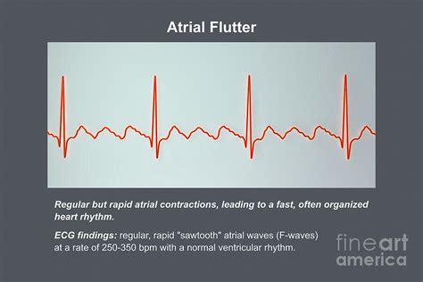 Ecg In Atrial Flutter 2 Photograph By Kateryna Kon Science Photo Library Pixels Merch
