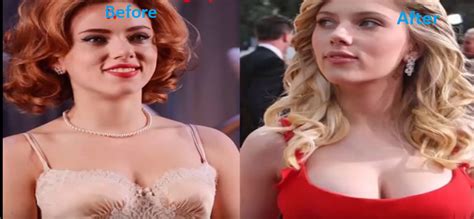 What About Scarlett Johanssons Breast Reduction Plastic Surgery