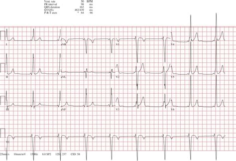 Electrophysiology Pacing And Defibrillation Thoracic Key