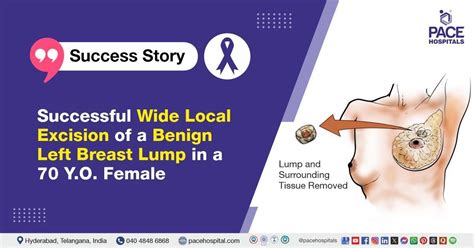 Benign Breast Lump Removed With Wide Local Excision