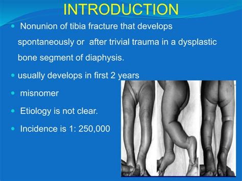 Congenital Pseudoarthrosis Of Tibia Pptx