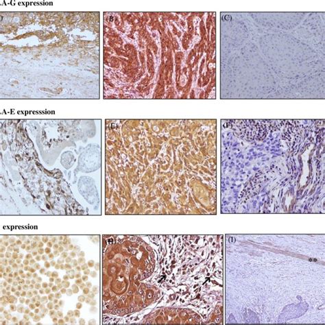 Representative Immunohistochimical Staining Of Hla‐g Hla‐e And Ido