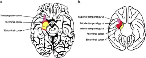 Figure 4 From Beyond The Ffa The Role Of The Ventral Anterior Temporal Lobes In Face Processing