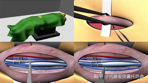 静脉曲张手术可以改善毛细血管扩张吗？ 知乎