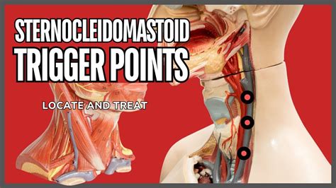 Understanding Trigger Points In The Sternocleidomastoid Muscle Youtube