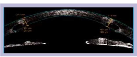 Anterior Segment Optical Coherence Tomography Showing The Precise Download Scientific Diagram