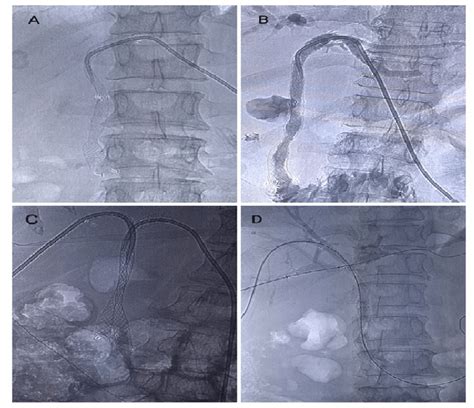 A Single System Biliary Stenting For Type 3a Cholangiocarcinoma From Download Scientific
