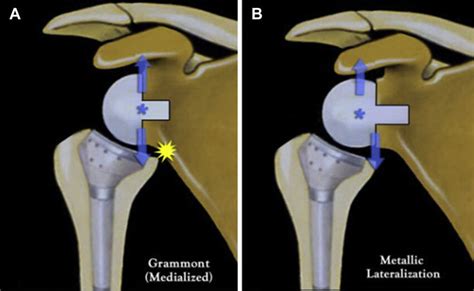 Diagrams Show Medialization Of The Glenoid Component Versus Download Scientific Diagram