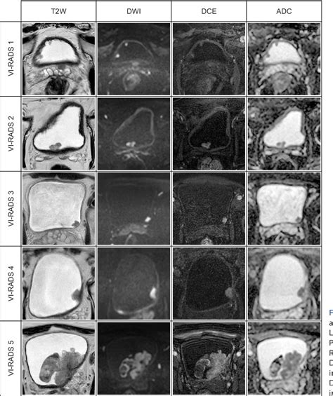 Figure 2 From Accuracy Of Vesical Imaging Reporting And Data System For Muscle Invasive Bladder