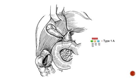 Choledochal Cysts Introduction Classification Pathogenesis And Management Pptx