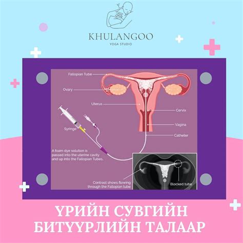 Үрийн сувгийн битүүрэл гэж юу вэ Үрийн суваг буюу Фаллопийн хоолой нь умайн хоёр тал дээр